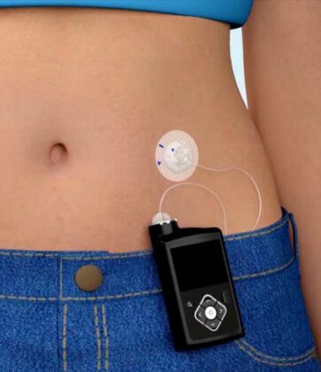 Pompe à insuline sans fil : Quels sont les meilleurs modèles